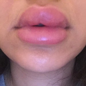 lip looks swollen