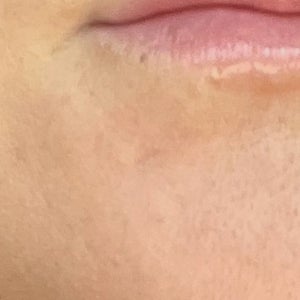 hypopigmentation scar