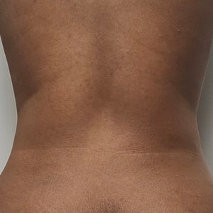 what causes back dimples
