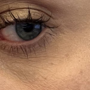 bumpy texture under eyes