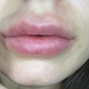 Vermillion Border Of Mouth