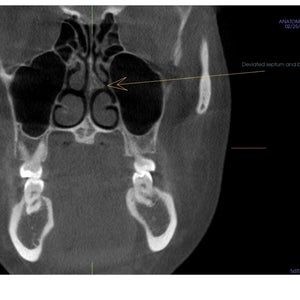 maxillary sinus bone spur