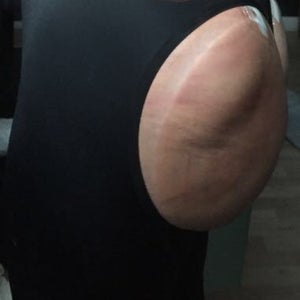 fat necrosis buttocks