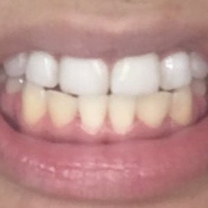 whitest teeth ever
