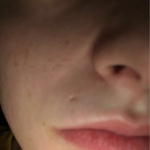 can you get a dermal piercing over scar tissue