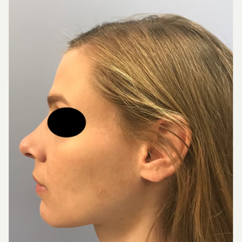 Supraorbital Ridge Reduction