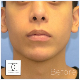 Cleft Chin Surgery Before After