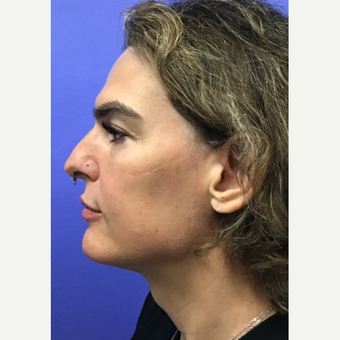Transgender Surgery Before And After Photos
