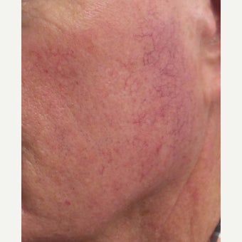 Rosacea Treatment Before & After Pictures - RealSelf