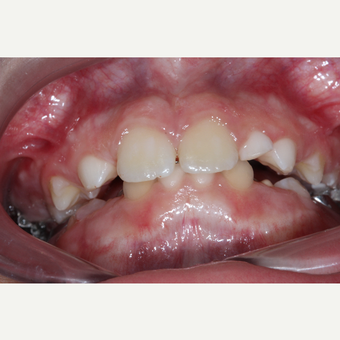 Superior Labial Frenulum