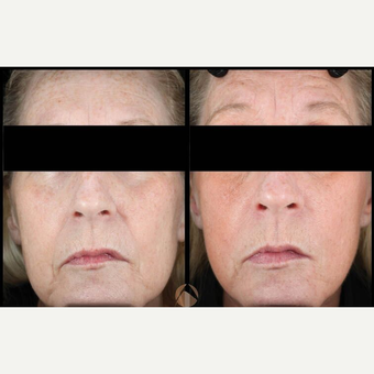 Profound RF Before & After Pictures - RealSelf