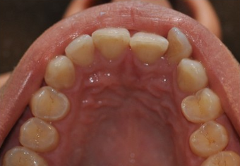 Incisor sticking out with misshapen front teeth photo from Raj Kumar ...