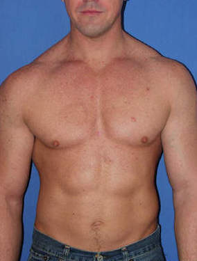 Pectoral Implants Celebrity