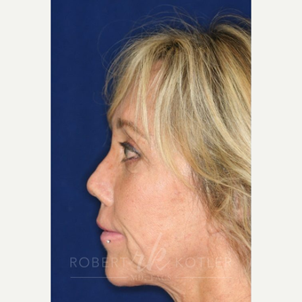 Mister Mark Silicone Injections