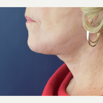 Lower Face Lift Before & After Pictures - RealSelf