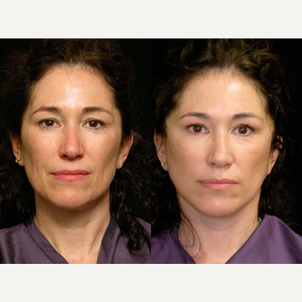 Thread Lift Before & After Pictures - RealSelf