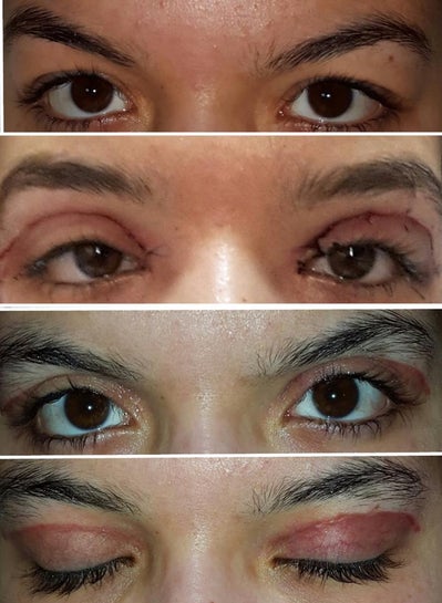 Blepharoplasty Scars