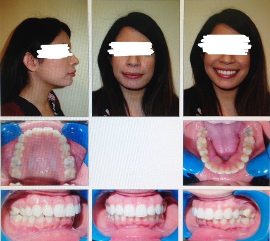 braces overbite teeth extraction