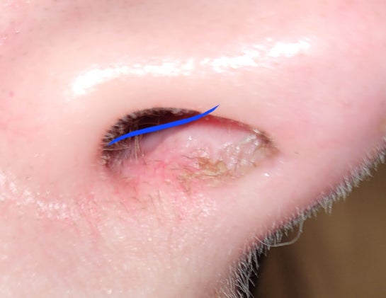 why is my nose scabby and sore inside