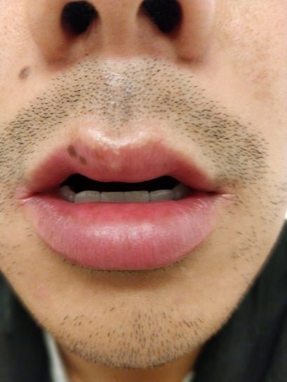 Angular Cheilitis Scars