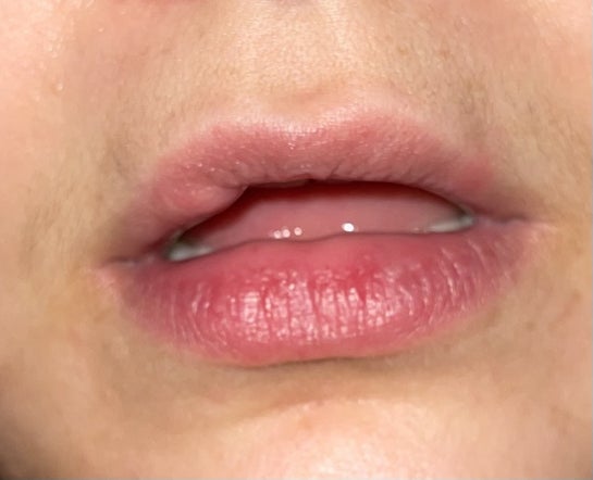 Lip Scar Bump Treatment