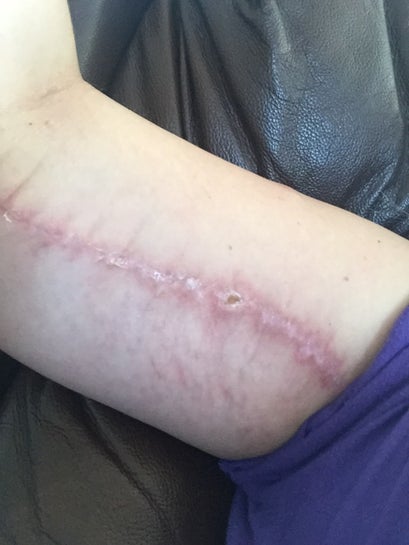 brachialis stretch marks