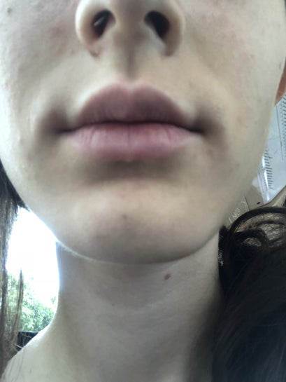 Fat Transfer Lips Melbourne | Lipstutorial.org Fat Transfer Lips Melbourne | Lipstutorial.org