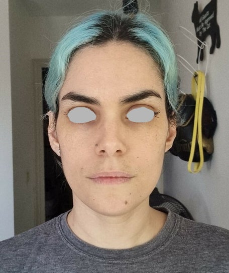 forehead bone shaving