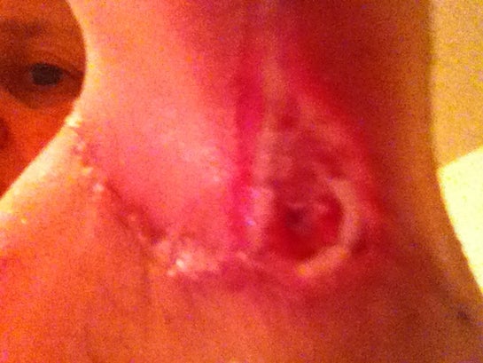 granulation tissue armpit