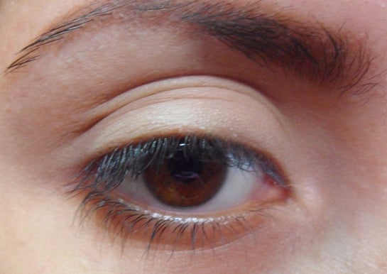 Upper Eyelid Fold
