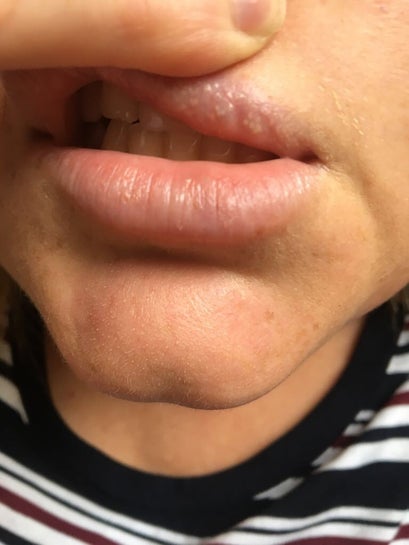 bump on upper lip