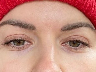 upper eyelid fold