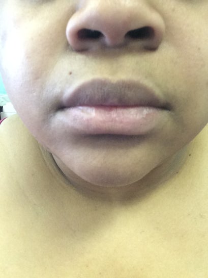 Philtrum Piercing Scar