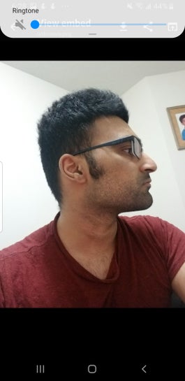 Gonial Angle