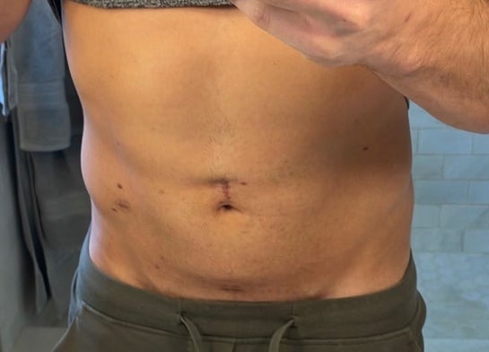 Appendix Removal Scar