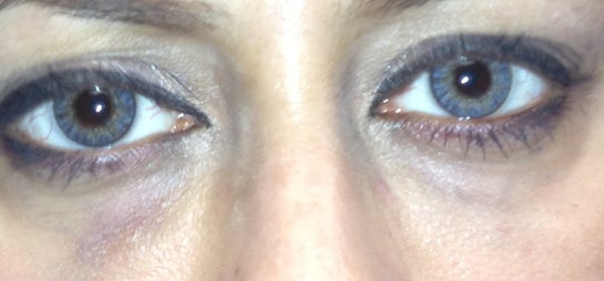 Tyndall Effect Juvederm