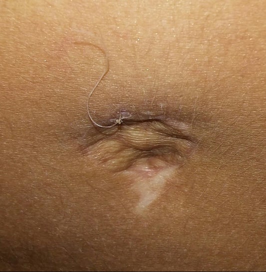 laparoscopy belly button stitches