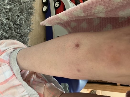 Liposuction Scars Legs