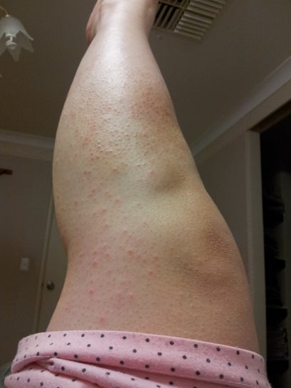 Red Itchy Rash On Legs After Shower - Infoupdate.org