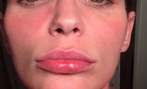 Yellow Spots On Lips After Filler Treatment - Infoupdate.org