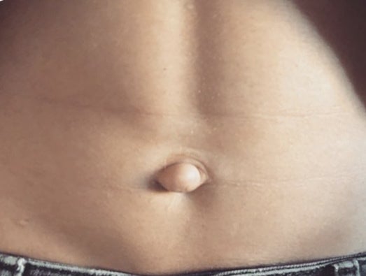 belly button outie