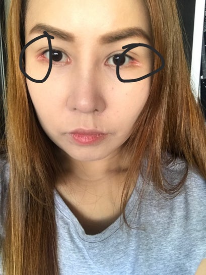 Lateral Canthoplasty Recovery