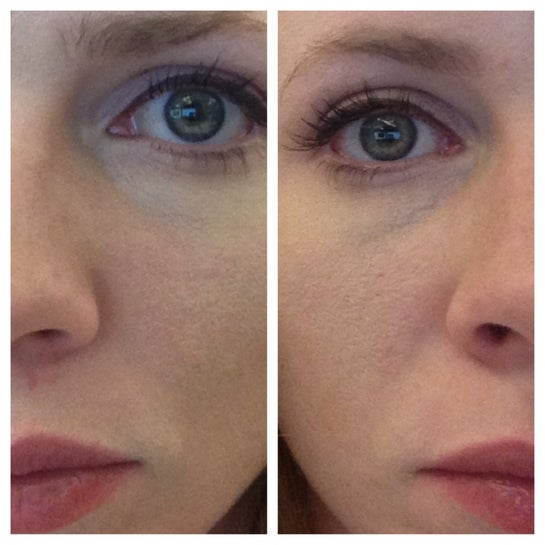 Nasolacrimal Groove Filler