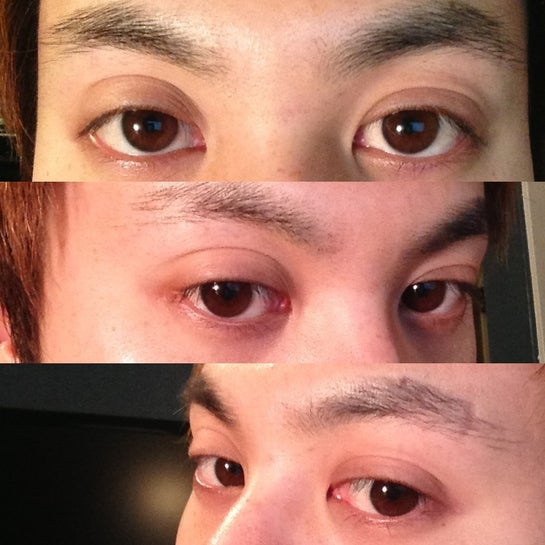 Uneven Eyelid Crease