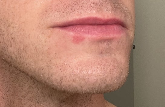 What Does Cold Sore Scar Look Like - Infoupdate.org