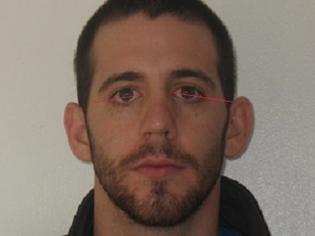 Negative canthal tilt, in which ethnicities is it most common?