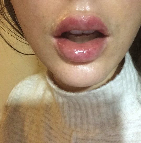 Restylane Lips Swelling