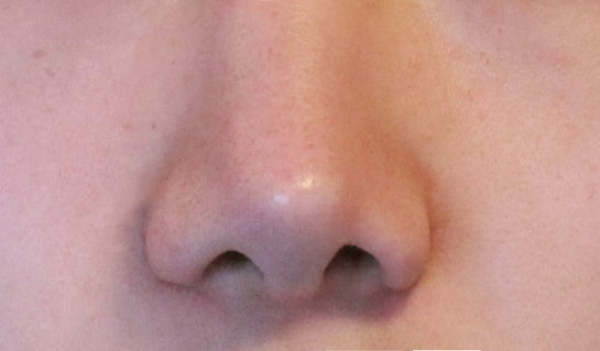 Skin Atrophy Nose