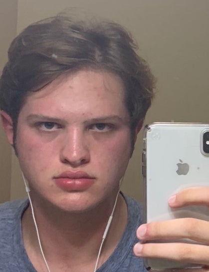 Hypertelorism