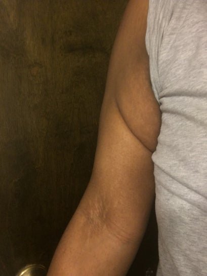 What Is The Crease In Your Arm Called